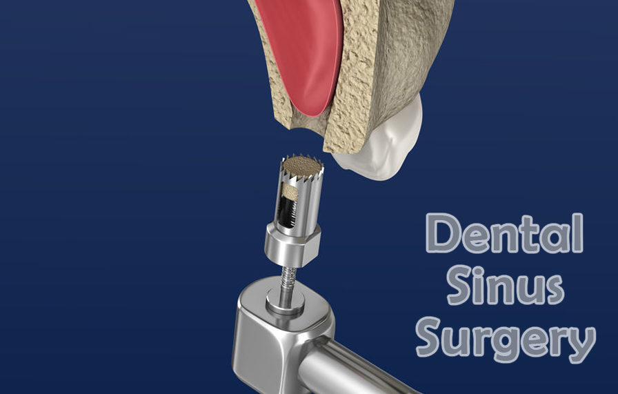 Sinus Elevation Surgery | Dr. Homing Kim, DDS